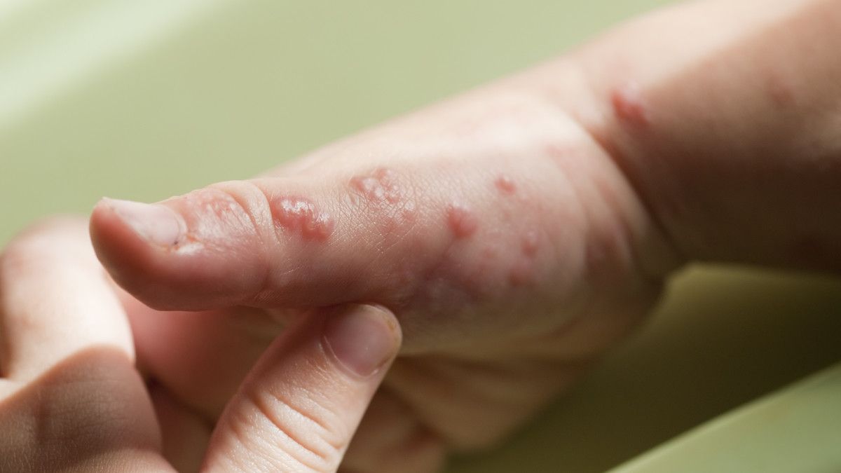 Gejala Cacar Air pada Bayi yang Harus Diwaspadai - KlikDokter