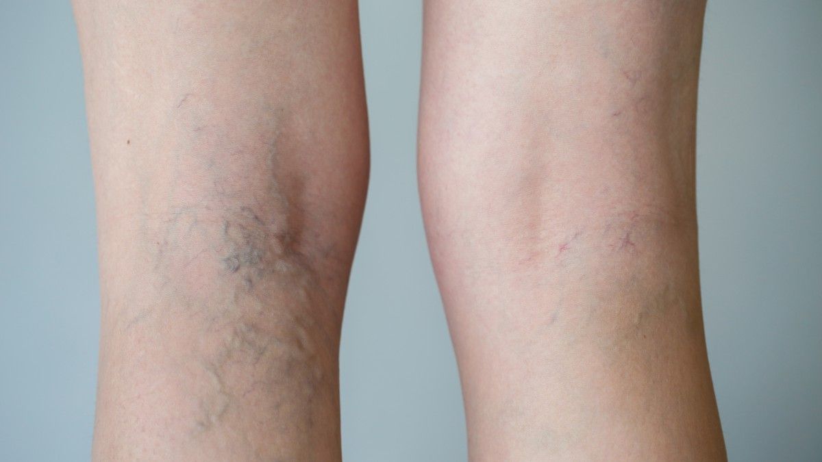 Chronic Venous Insufficiency - Penyebab, Gejala, Pengobatan - KlikDokter