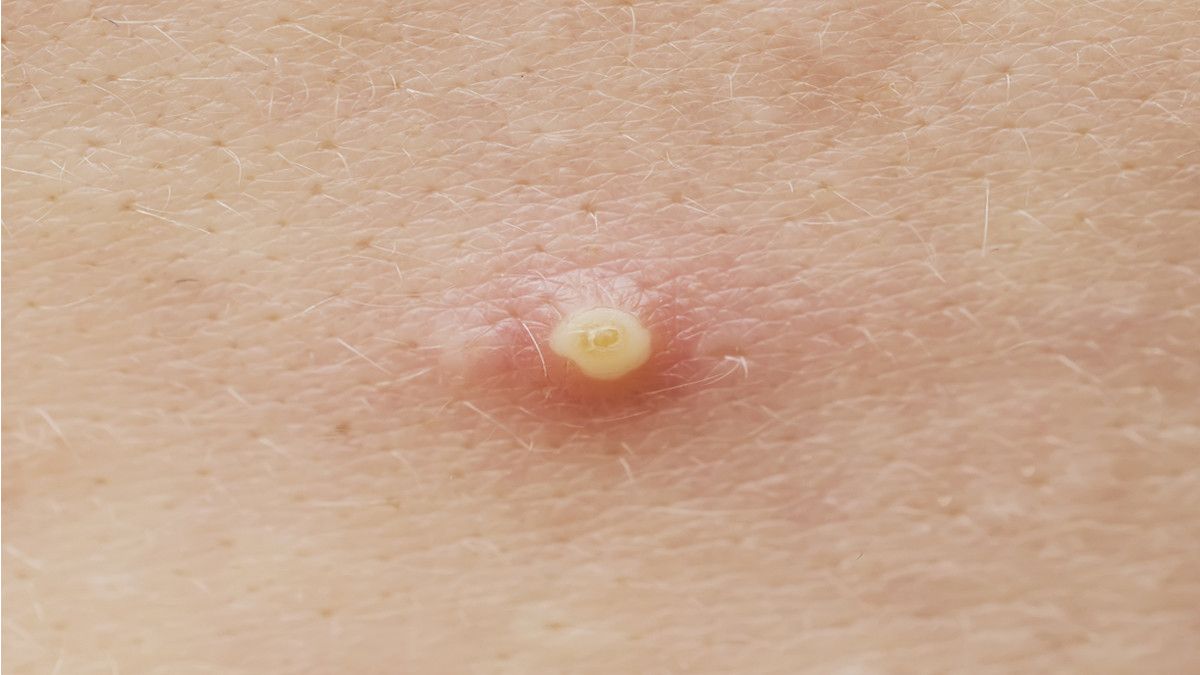 Makanan Penyebab Bisul, Mitos atau Fakta? - KlikDokter