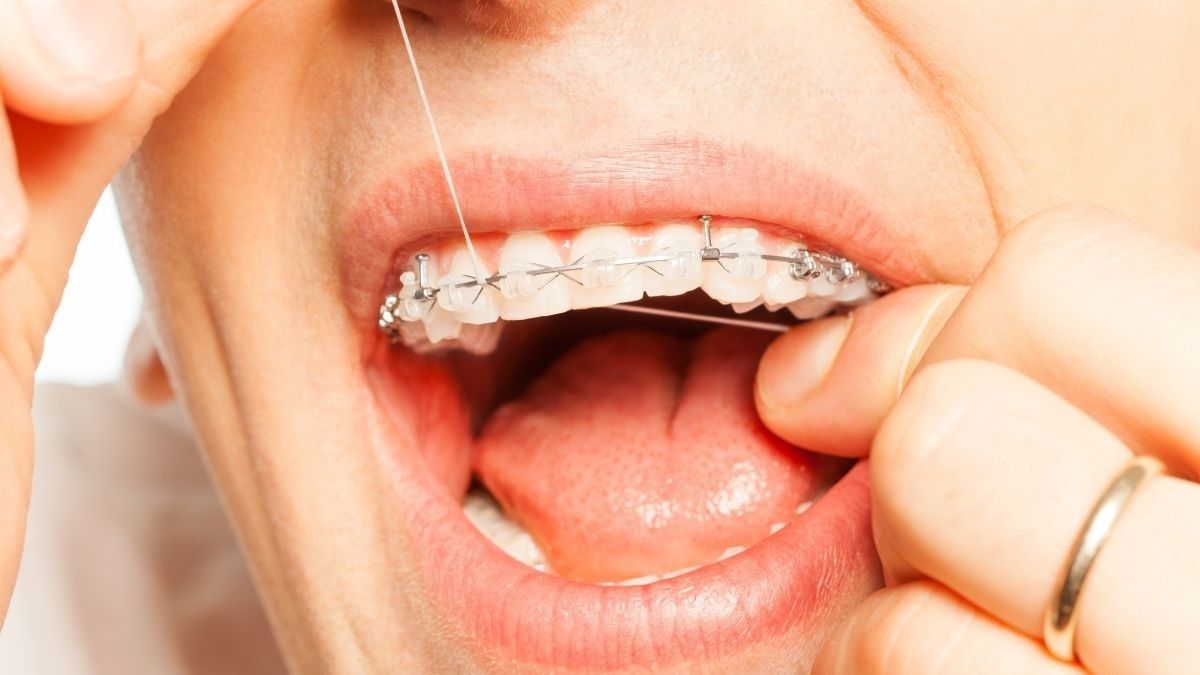 Cara Flossing Gigi yang Benar untuk Pengguna Behel - KlikDokter