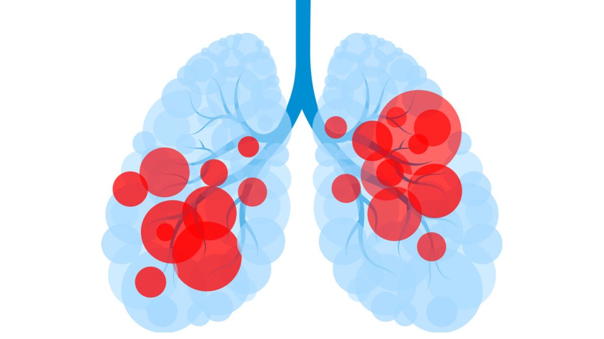 Ribuan Orang yang Sembuh dari COVID-19 Bisa Alami Kerusakan Paru ...