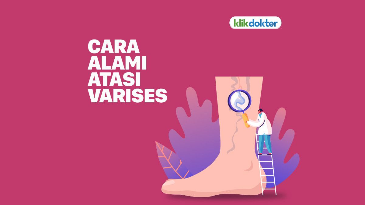 Atasi Varises dengan Skleroterapi, Efektifkah? - KlikDokter