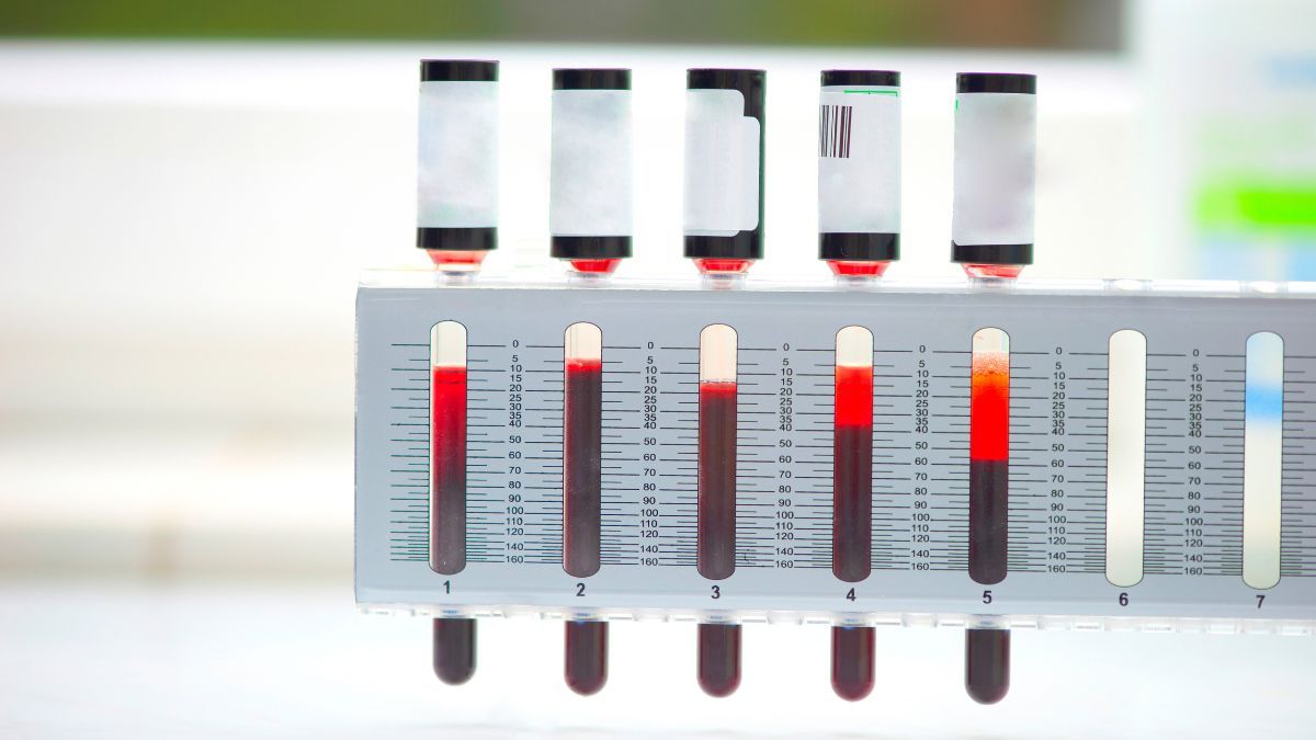 Hasil Laju Endap Darah (LED) Tinggi, Apakah Artinya Berbahaya? - KlikDokter