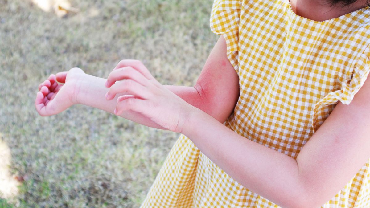 Mirip Eksim, Berikut 5 Gejala Scabies yang Perlu Diwaspadai - KlikDokter