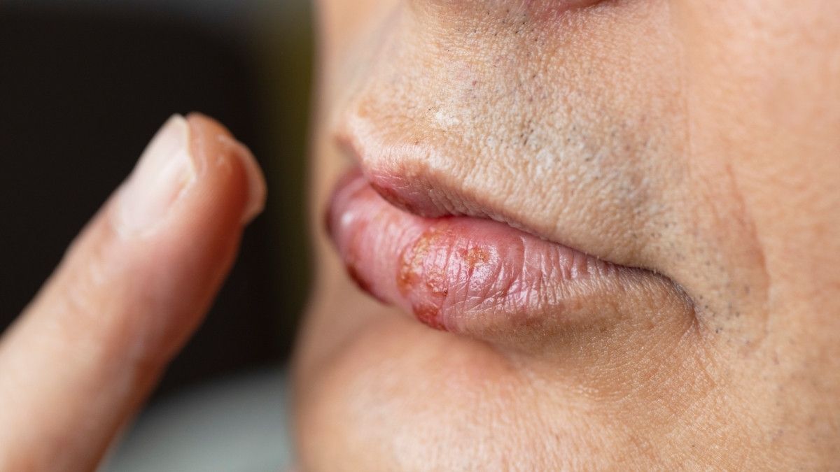 Penyakit Mulut pada Penderita HIV dan Pengobatannya - KlikDokter