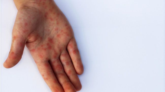 Mengenal Penanganan Awal Cacar Monyet - KlikDokter