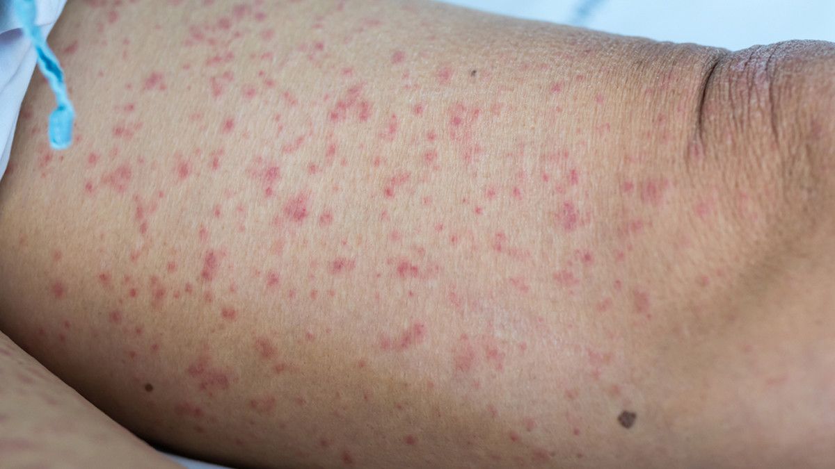 TBC juga Bisa Menyerang Kulit, Kenali Gejalanya! - KlikDokter