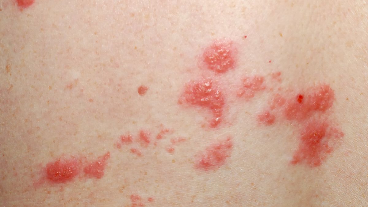 Benarkah Penyakit Cacar Ular Bisa Menyebabkan Kematian? - KlikDokter