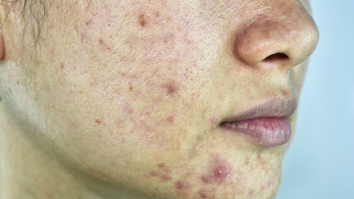 Mengenal Perbedaan Jerawat Purging dan Breakout - KlikDokter