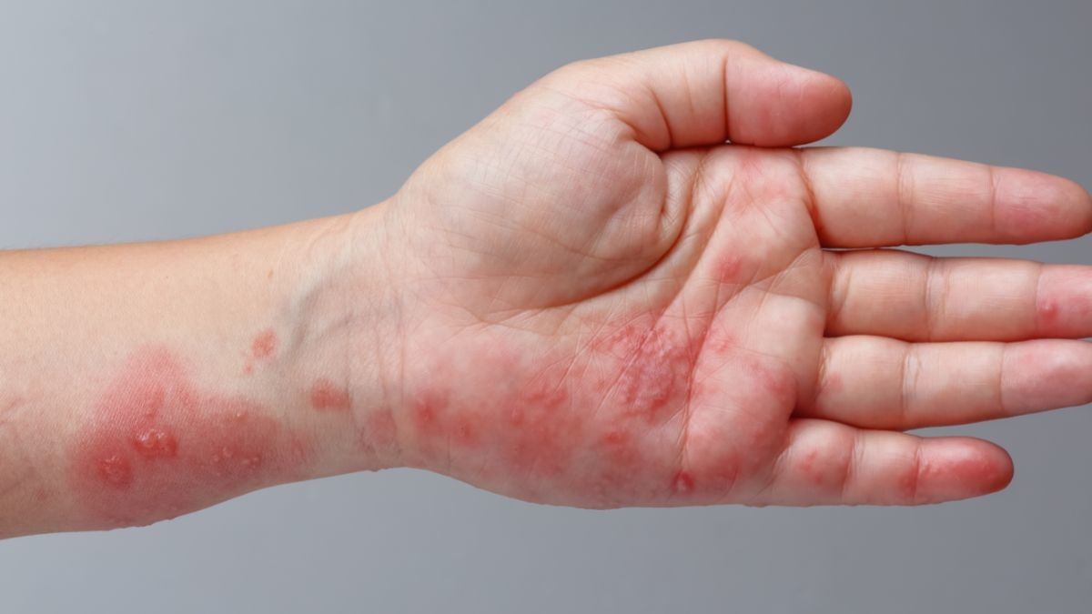 Penyebab Sindrom Ramsay Hunt yang Bikin Wajah Lumpuh - KlikDokter