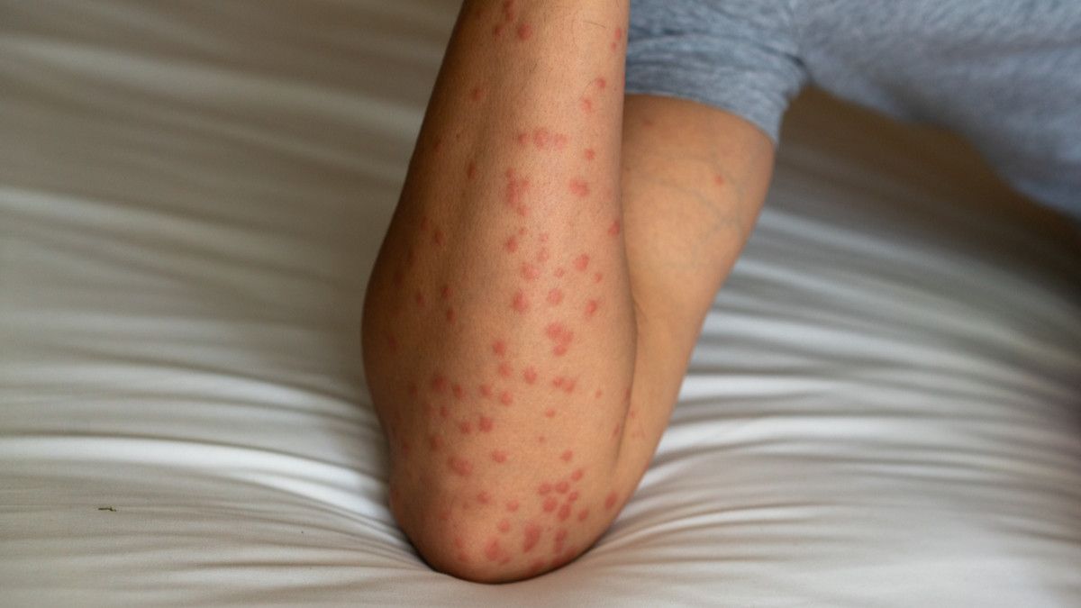 Mengenal Sindrom Skeeter, Reaksi Alergi Gigitan Nyamuk - KlikDokter