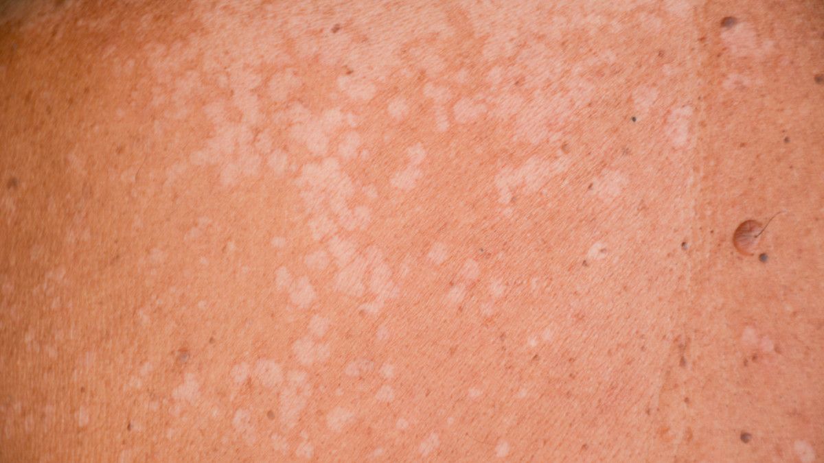 Nizoral - Fungsi, Dosis, Efek Samping - KlikDokter