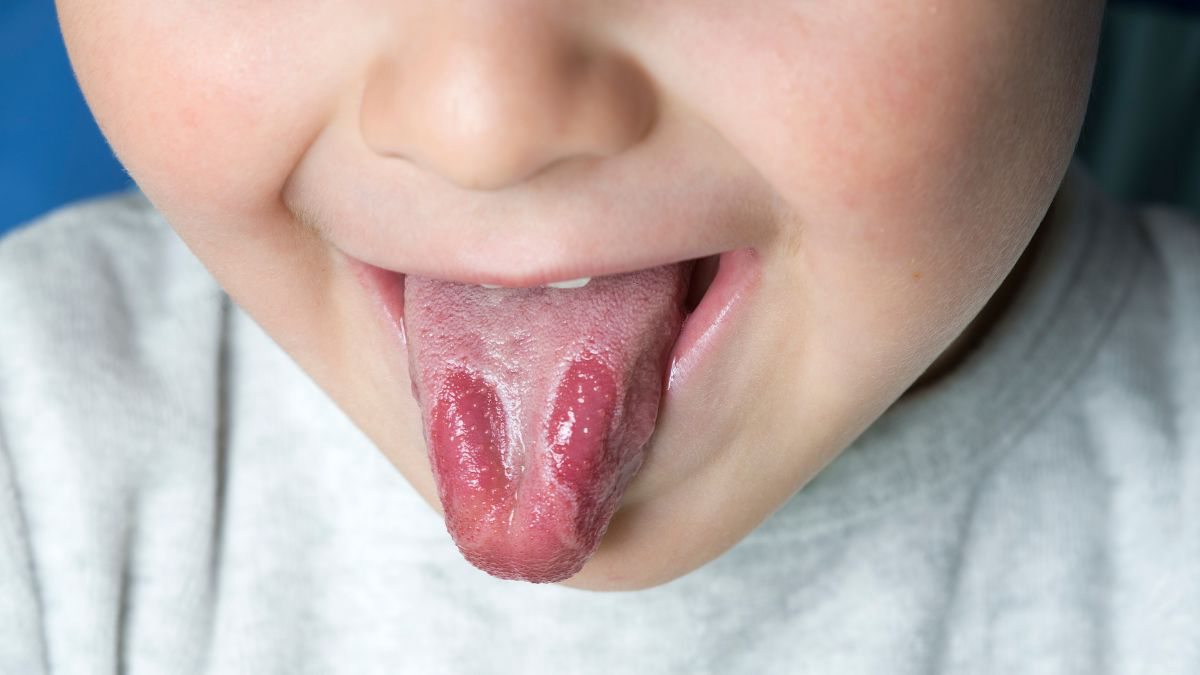 Geographic Tongue - Penyebab dan Cara Mengobati - KlikDokter
