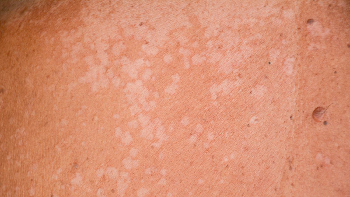 Jarang Diketahui, Panu Punya Banyak Warna, Adakah Artinya? - KlikDokter