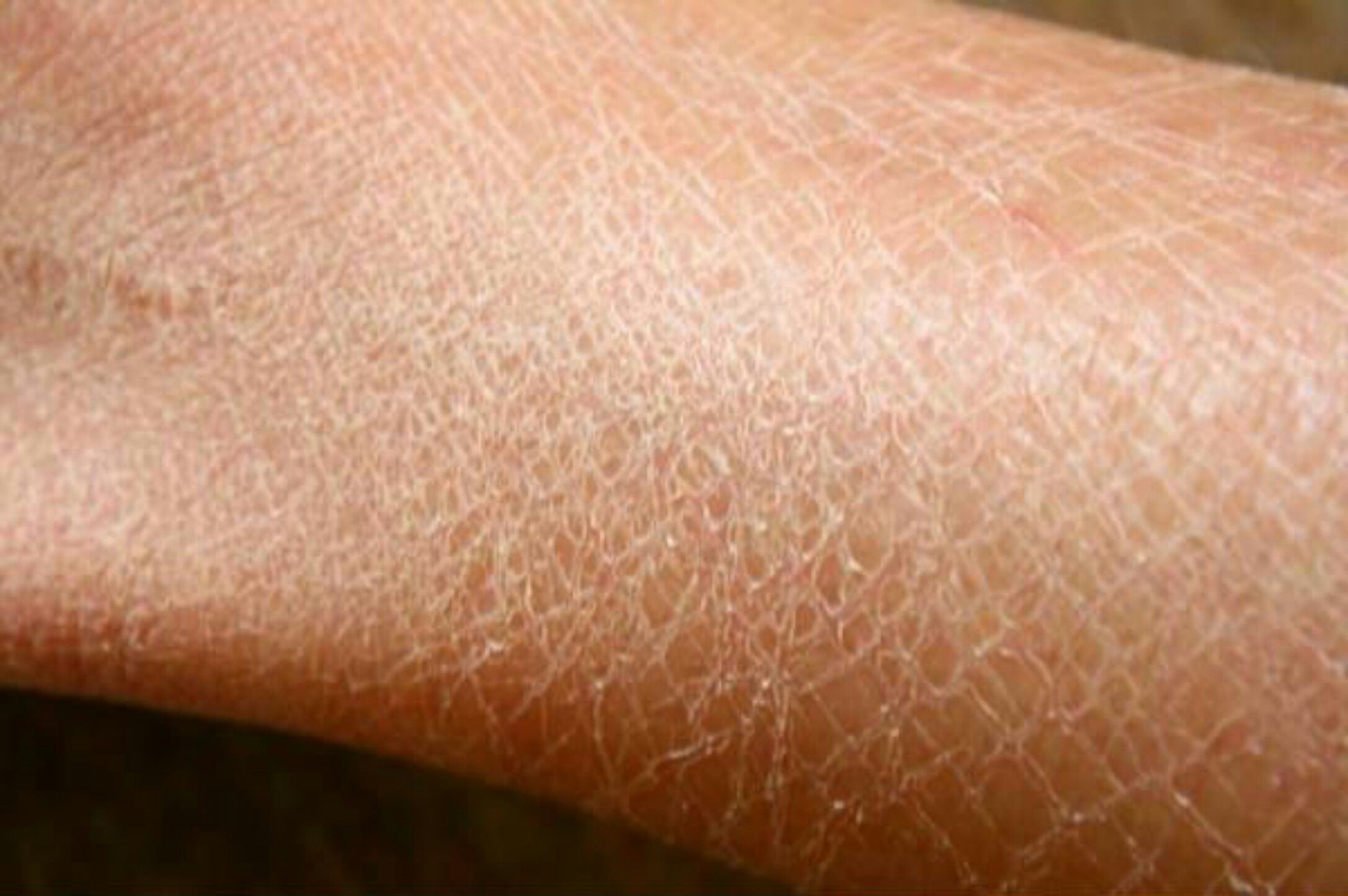 Xerosis Fingertips at Alexis Dawkins blog