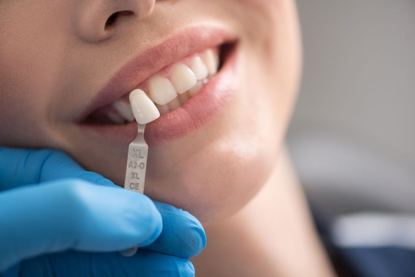 3 Ciri Veneer Gigi Gagal yang Harus Kamu Tahu - KlikDokter