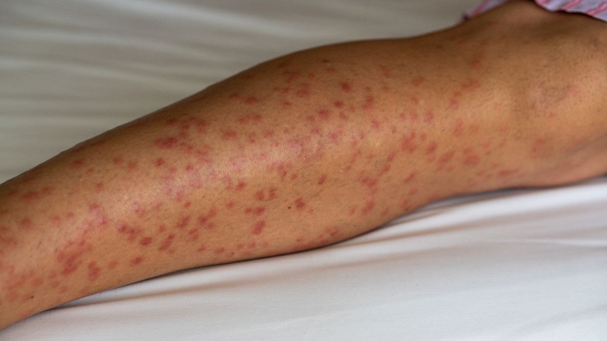 Mengenal Gejala dan Penyebab Psoriasis Gutata - KlikDokter