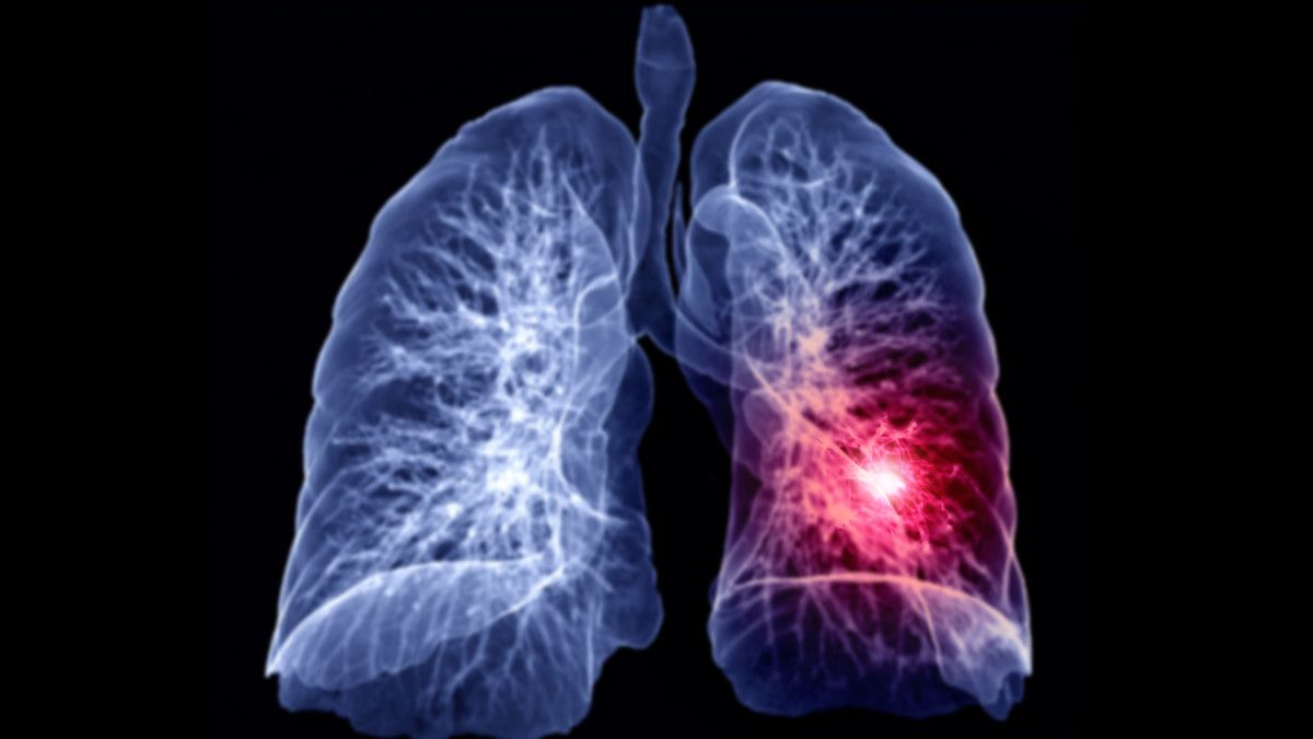 Waspadai Bahaya Penularan TB Paru! - KlikDokter