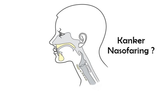 Mengenal Kanker Nasofaring Lebih Jauh - KlikDokter