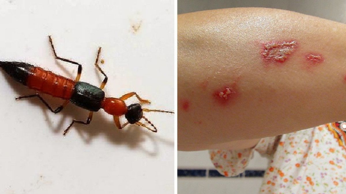 Viral Kondisi Kulit Akibat Semut Charlie, Ini Fakta Medisnya - KlikDokter