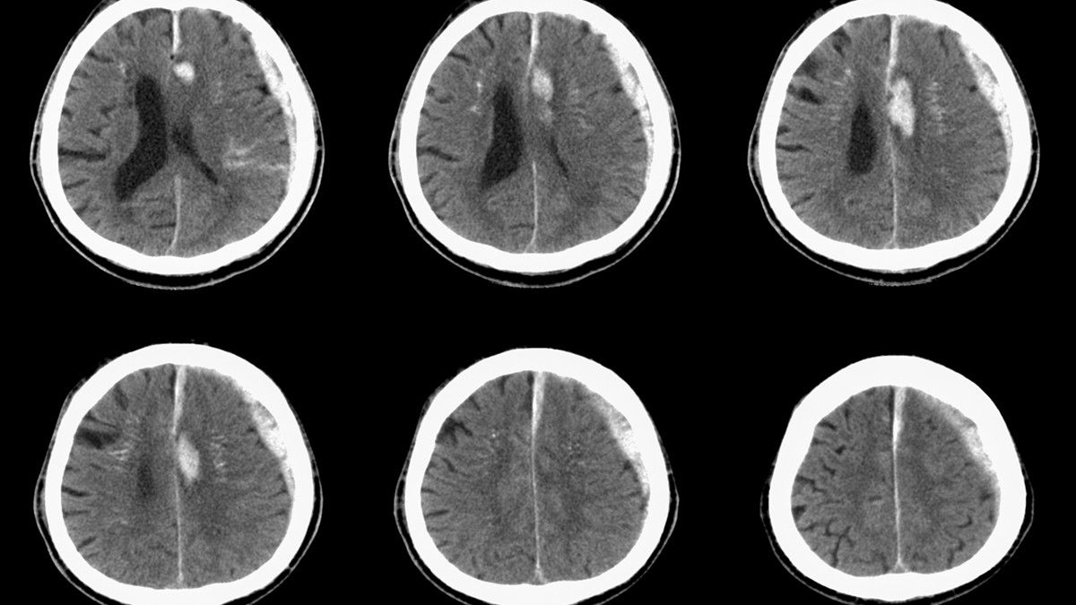Mengenal Penyakit Hematoma Subdural, Perdarahan di Lapisan Otak ...