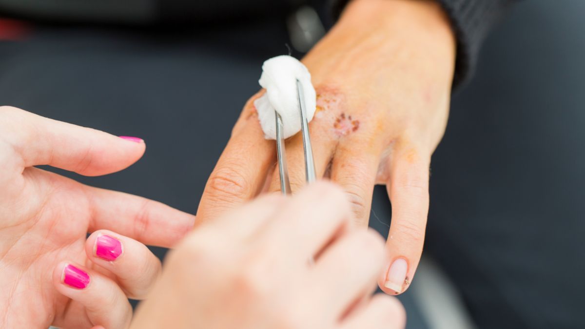 Jangan Keliru, Ini 4 Jenis-Jenis Luka dan Cara Tepat Merawatnya ...