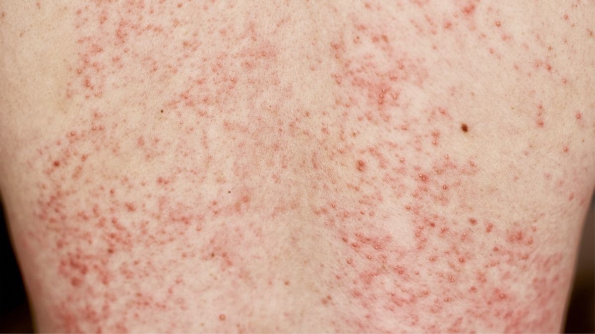 Tak Boleh Kena Matahari, Kenali Gejala Xeroderma Pigmentosum - KlikDokter