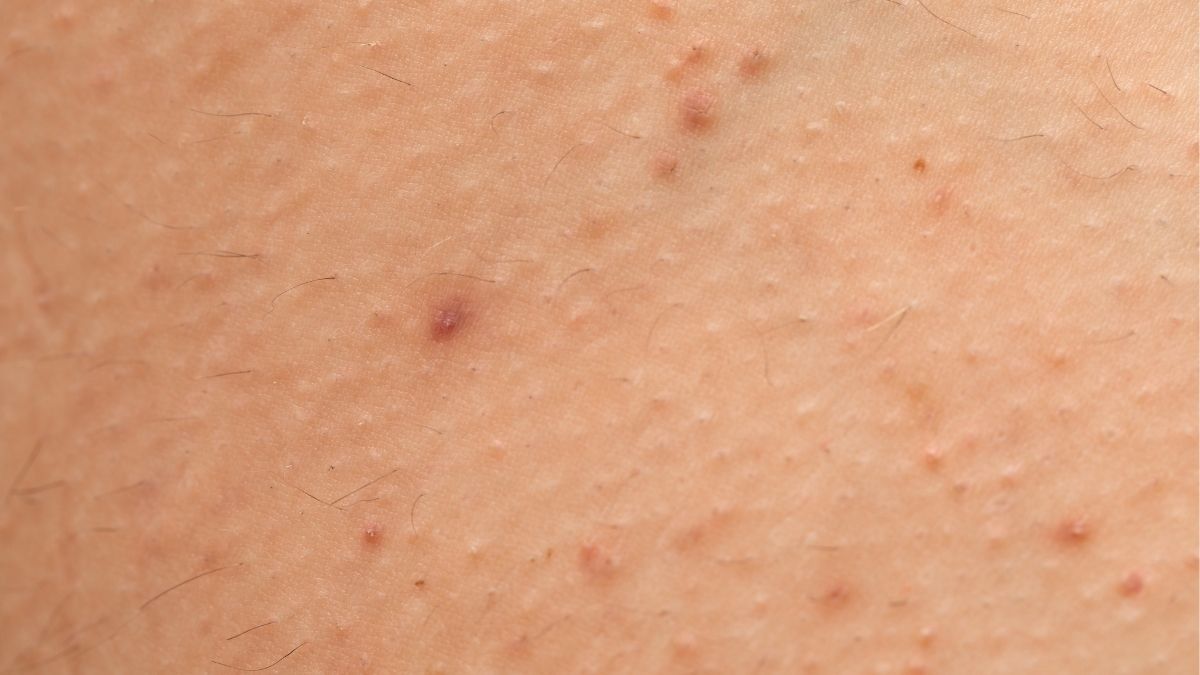 7 Penyebab Ketiak Gatal, Cepat Atasi! - KlikDokter