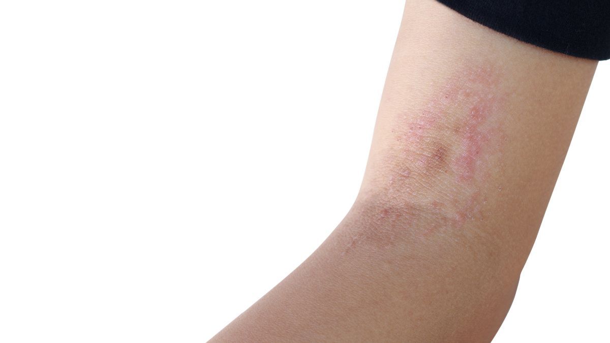 7 Ciri-Ciri Kurap Akan Sembuh - KlikDokter