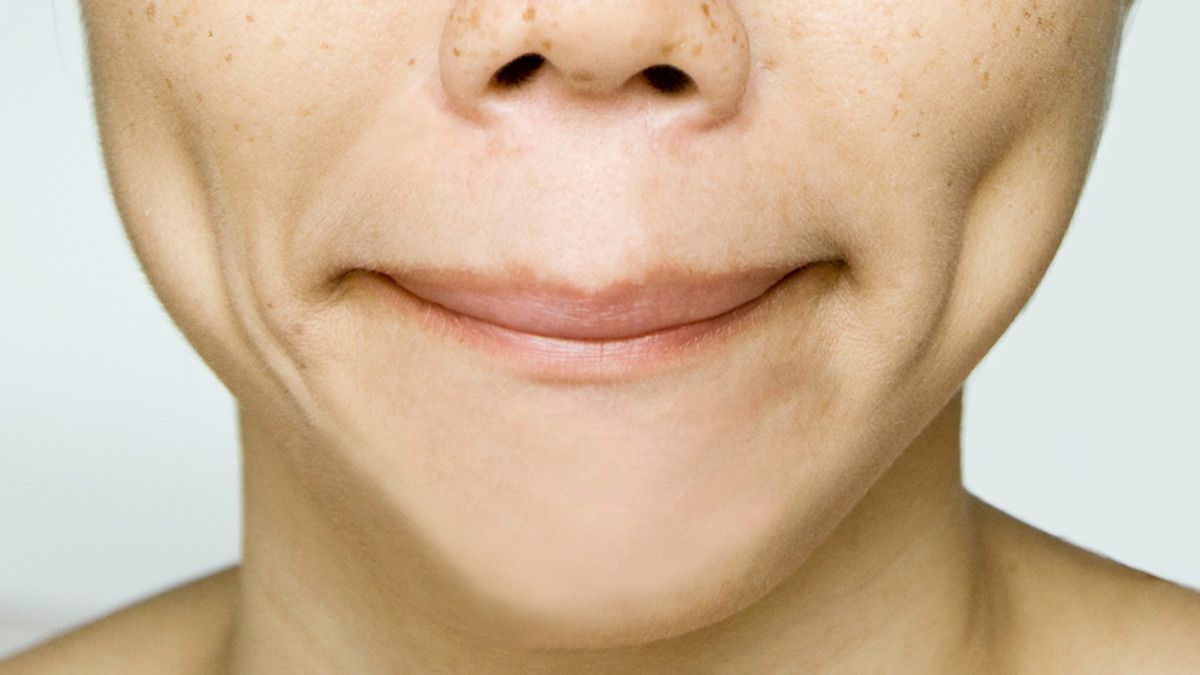 Sulam Lesung Pipi, Amankah? - KlikDokter