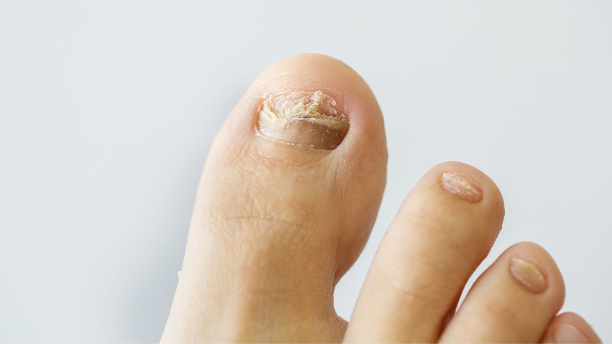 11 Jenis Kurap, Muncul di Kepala Hingga Kaki - KlikDokter