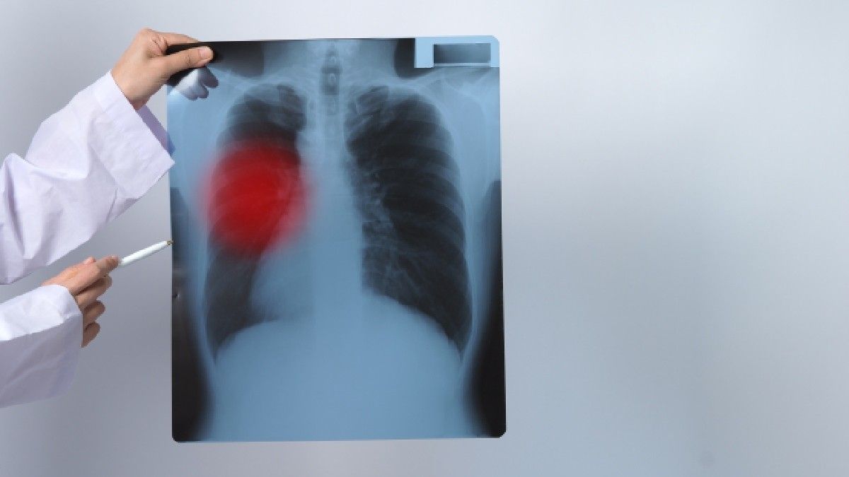 Seberapa Cepat Kanker Paru Menyebar ke Organ Lain? - KlikDokter