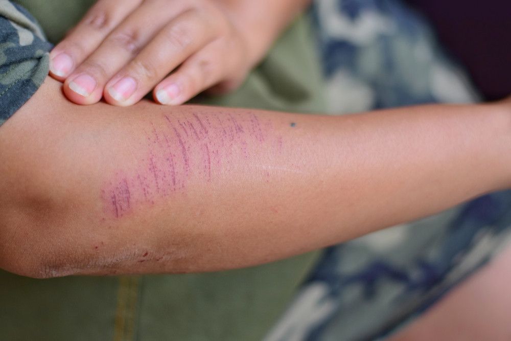 5 Penyebab Tubuh Anda Mudah Memar - KlikDokter