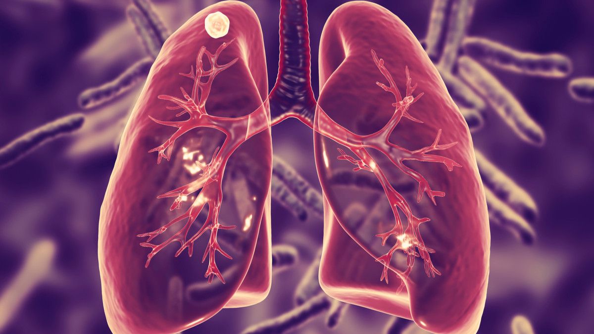 Kenali Gejala Awal Tuberkulosis (TBC) - KlikDokter