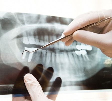 Ketika Gigi Perlu di Rontgen - KlikDokter