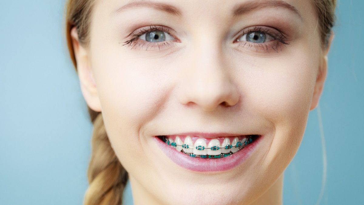10 Kondisi Gigi yang Perlu Pakai Behel, Apa Saja? - KlikDokter