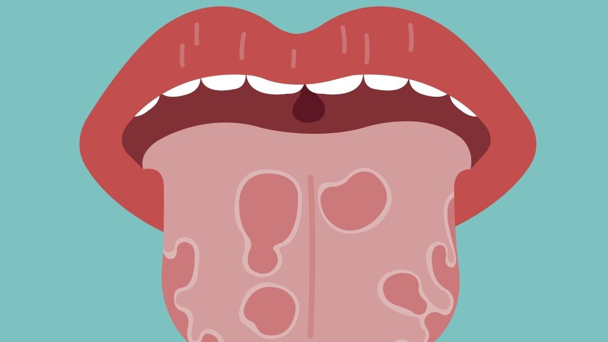Kelainan Lidah yang Perlu Anda Waspadai - KlikDokter
