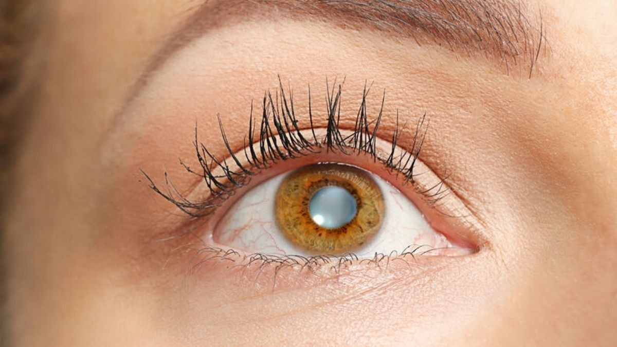 Kenali Penyebab Katarak agar Bisa Dicegah dari Sekarang - KlikDokter