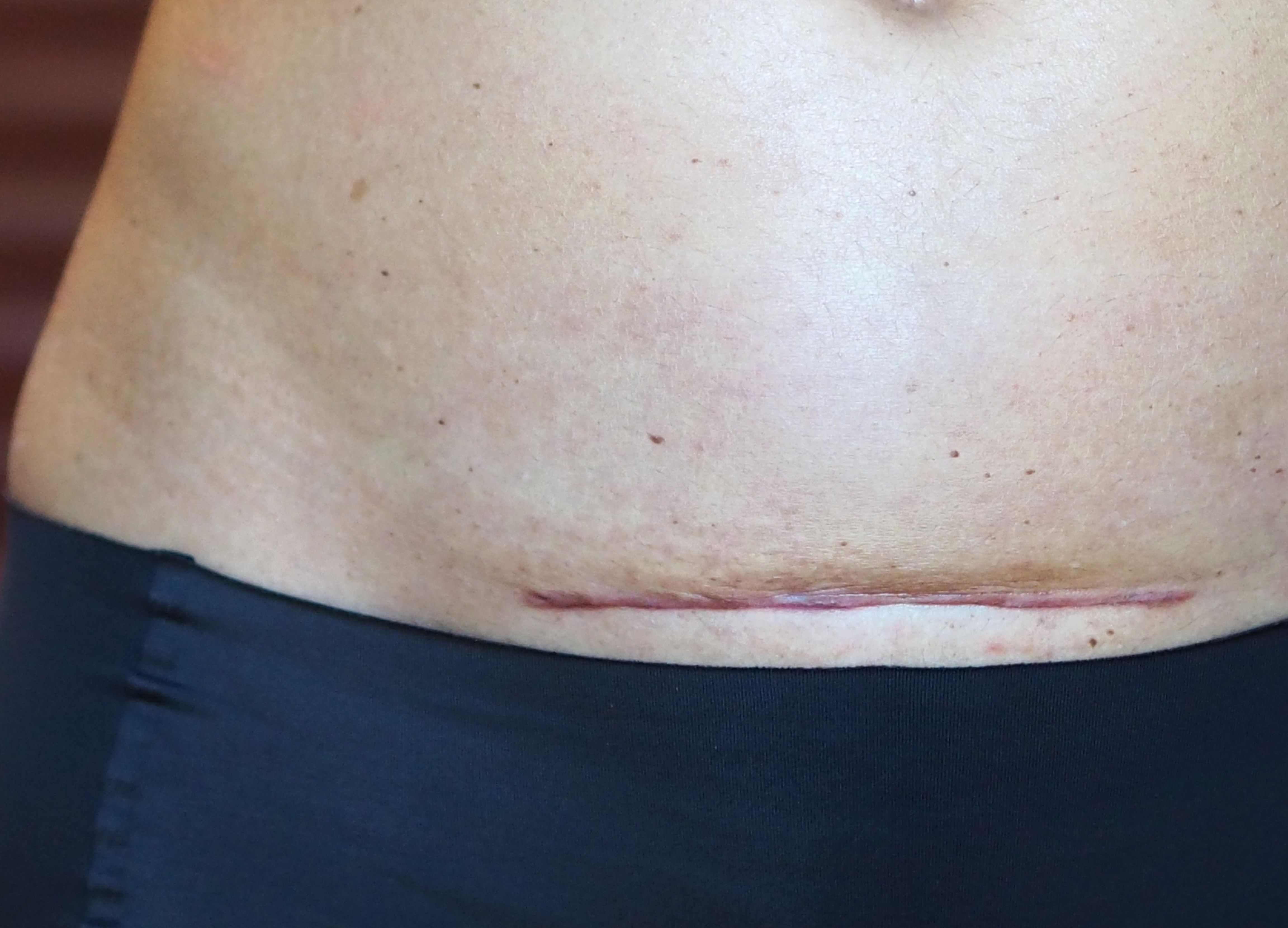 Berapa Lama Pemulihan Pasca Operasi Caesar? - KlikDokter