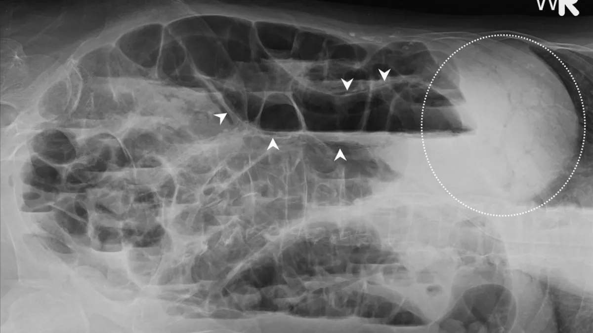 Mayoritas Pasien Positif Virus Corona Mengalami Pneumatosis, Apa Itu ...