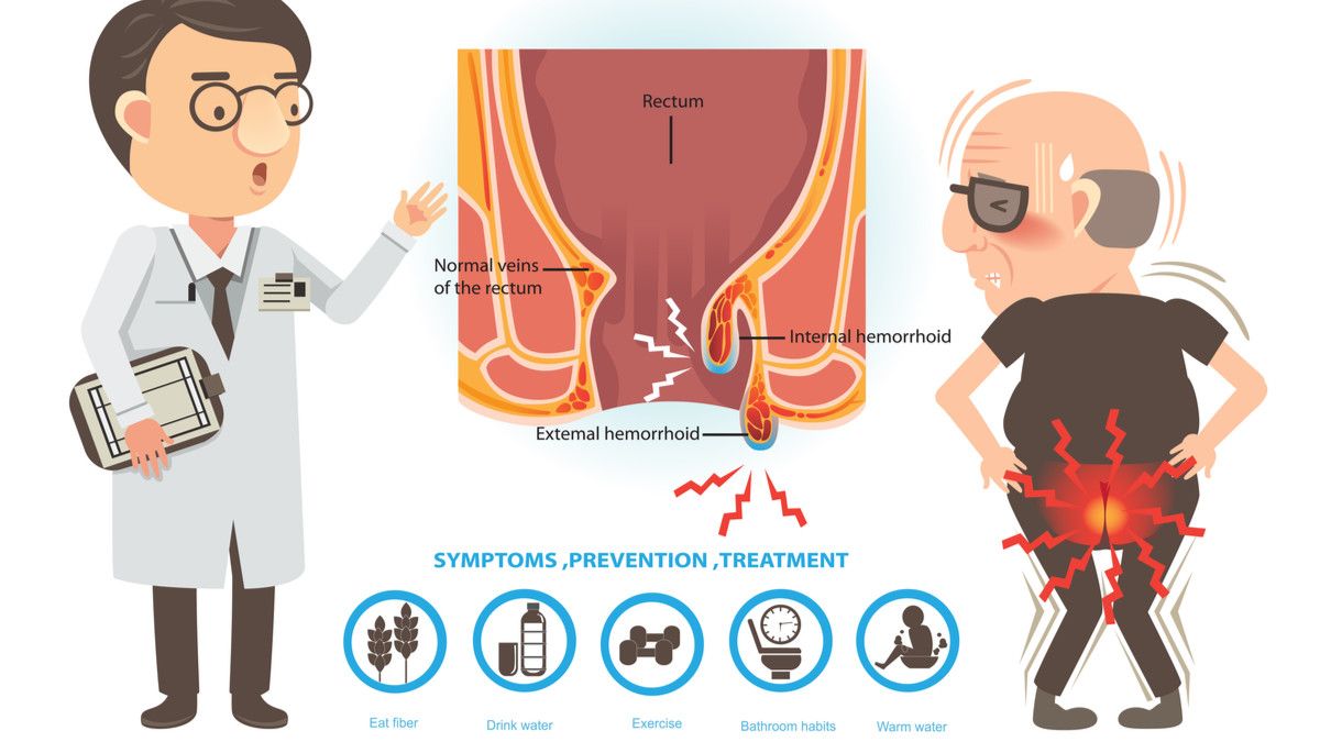 Apakah Wasir Merupakan Gejala Kanker Usus? - KlikDokter