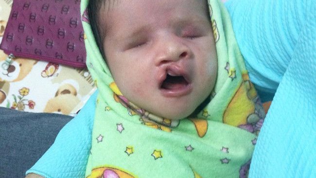 Inilah Penyebab Bayi Lahir dengan Bibir Sumbing - KlikDokter