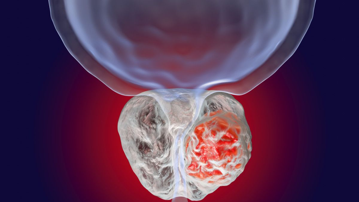 Bahaya Risiko, Gejala dan Komplikasi Kanker Prostat Pada Pria - KlikDokter