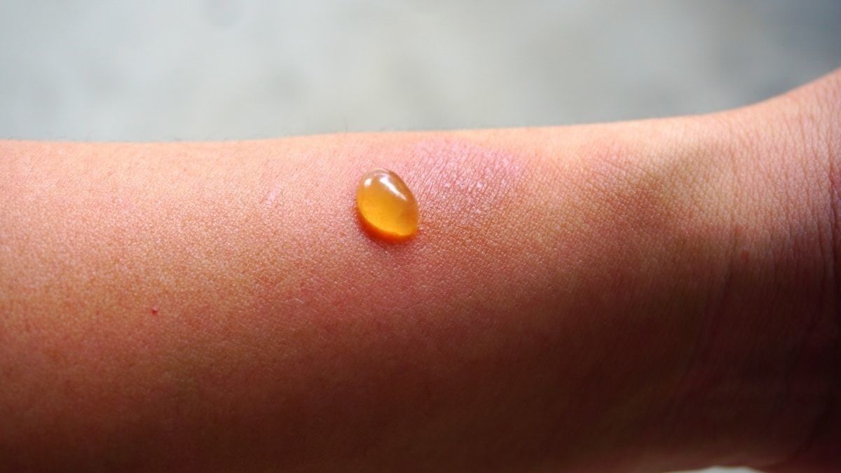 Nutrisi Penting Pencegah Kulit Lenting Lepuh atau Pemfigoid Bulosa ...