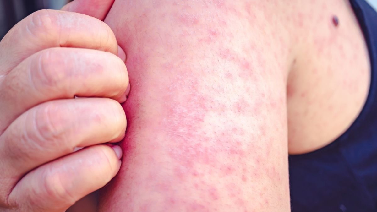 Penyakit Kulit Dermatitis Numularis, Bisakah Disembuhkan? - KlikDokter