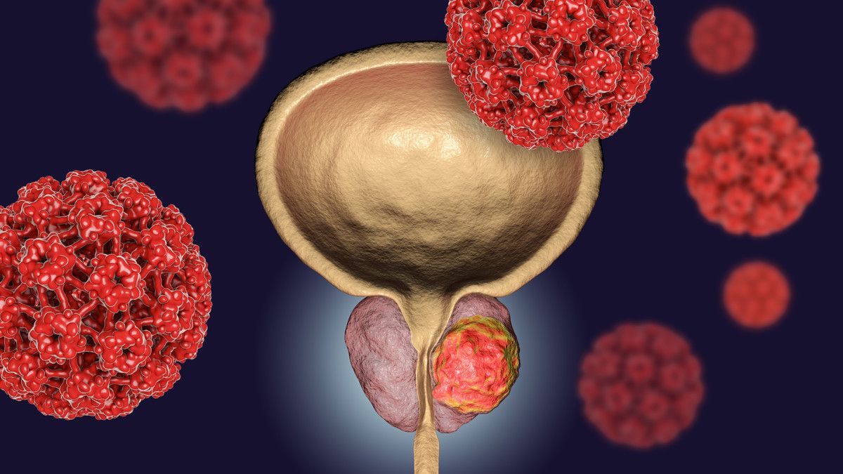 Kenali 5 Faktor Risiko Pemicu Kanker Prostat - KlikDokter