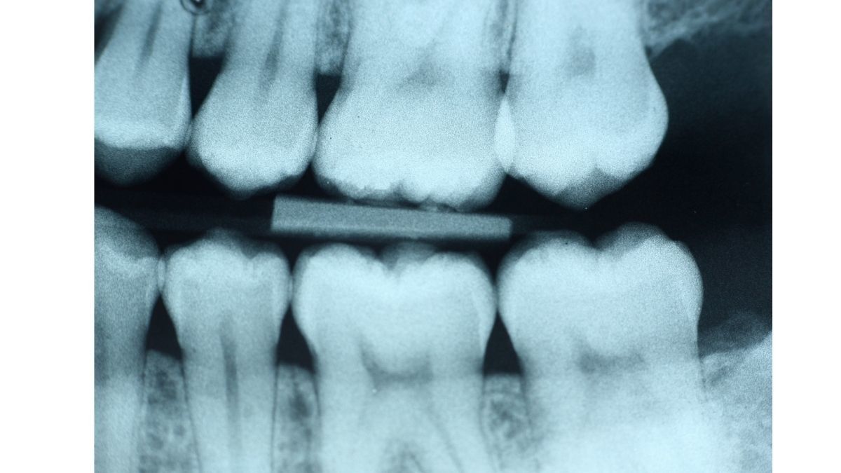 Tahapan Kerusakan Gigi dan Perawatan yang Bisa Dilakukan - KlikDokter