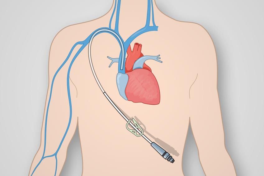 Apa yang Terjadi Selama Kateterisasi Jantung? - KlikDokter