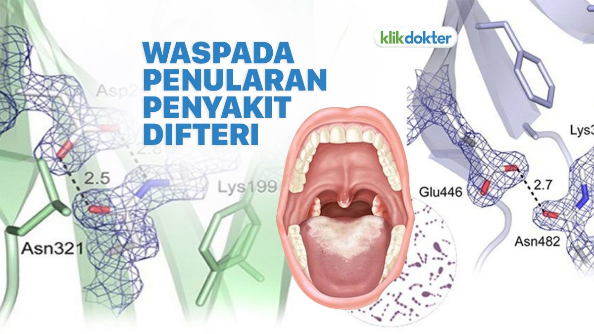 Waspada, Ini Cara Penularan Difteri - KlikDokter