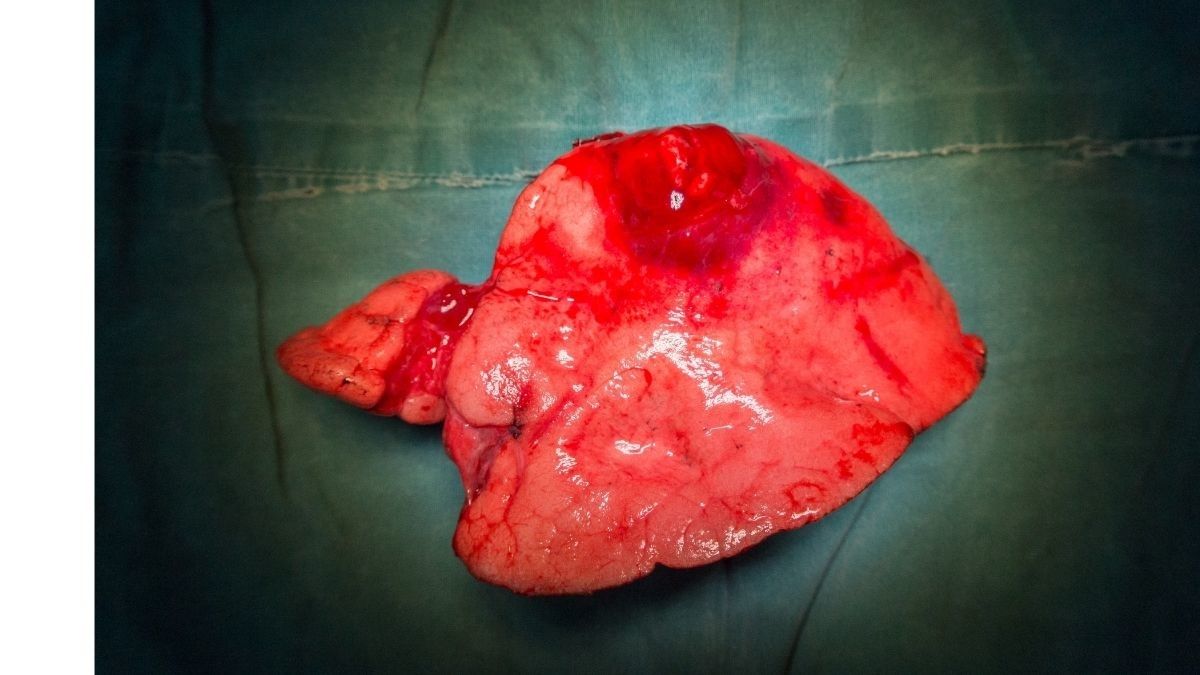 Jenis Jenis Kanker Pankreas Yang Perlu Anda Tahu Klikdokter